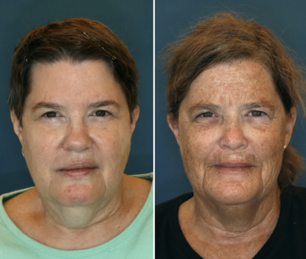 The Sun's Impact on Aging: Key Findings from a Twin Study - Entre Nous